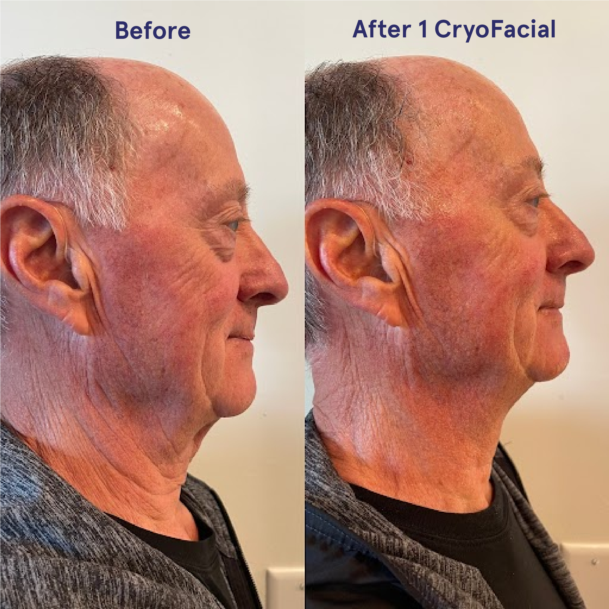 Before After Cryofacial Pictures